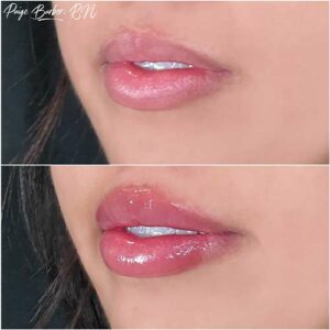 Lip Injections Before and After at Flawless Medspa